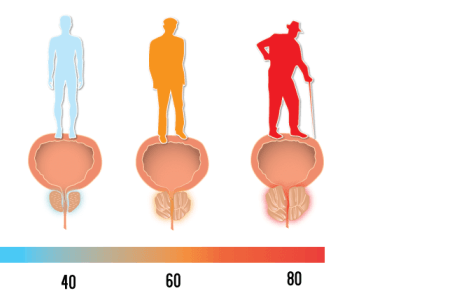 Benign prostata hyperplasi - Alt du skal vide om prostata problemer
