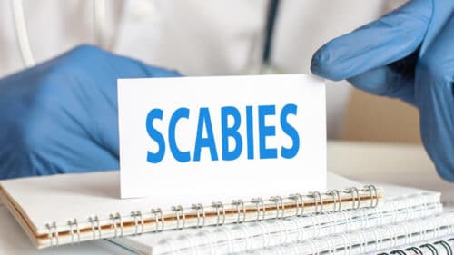 De 7 fnat symptomer og sådan behandler du effektivt (opdateret)